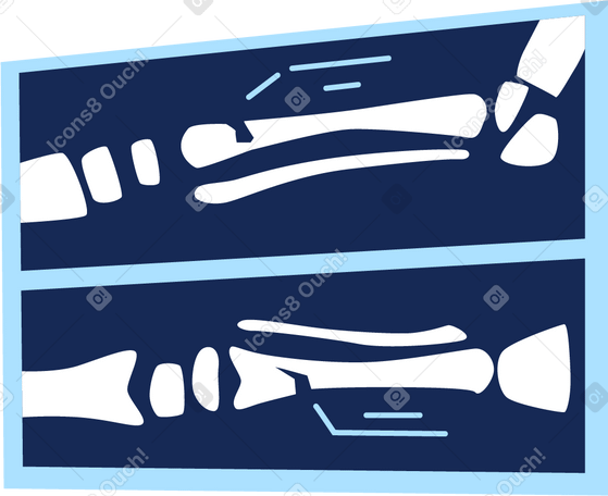 X Ray Of A Leg Fracture Png Svg